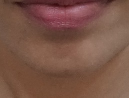 57 clinic botox story - episode 1 : คางขรุขระ (cobble stone chin)