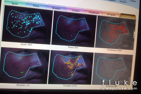 สรุปผลหลังเลเซอร์ กับเครื่อง Fine Touch ( Fine Scan ) ที่ APEX ครบ 5 ครั้ง