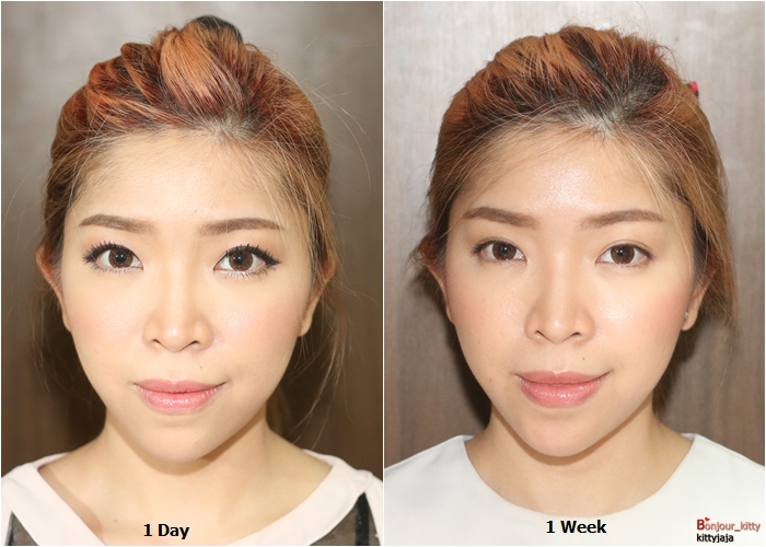 REVIEW>> หน้าเรียวสวยขึ้นด้วย Botox + Meso Fat ที่ Crystal Bright Clinic