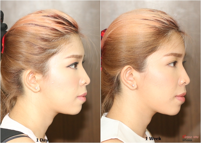 REVIEW>> หน้าเรียวสวยขึ้นด้วย Botox + Meso Fat ที่ Crystal Bright Clinic