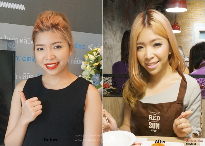 REVIEW>> หน้าเรียวสวยขึ้นด้วย Botox + Meso Fat ที่ Crystal Bright Clinic