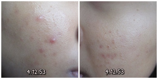 All About Acne : ผลการทดลองใช้ Isotrexin Gel