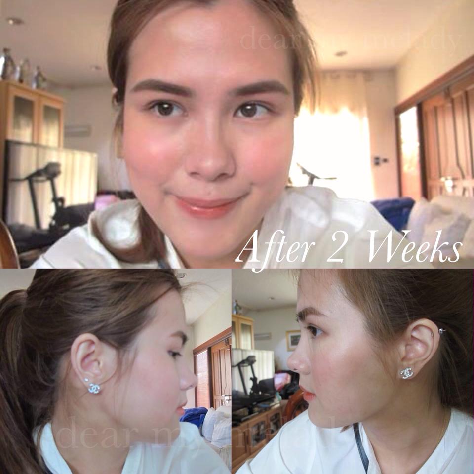 รีวิวฉีด Botox หน้าเรียว + เมโสแฟต ที่Crystal bright clinic