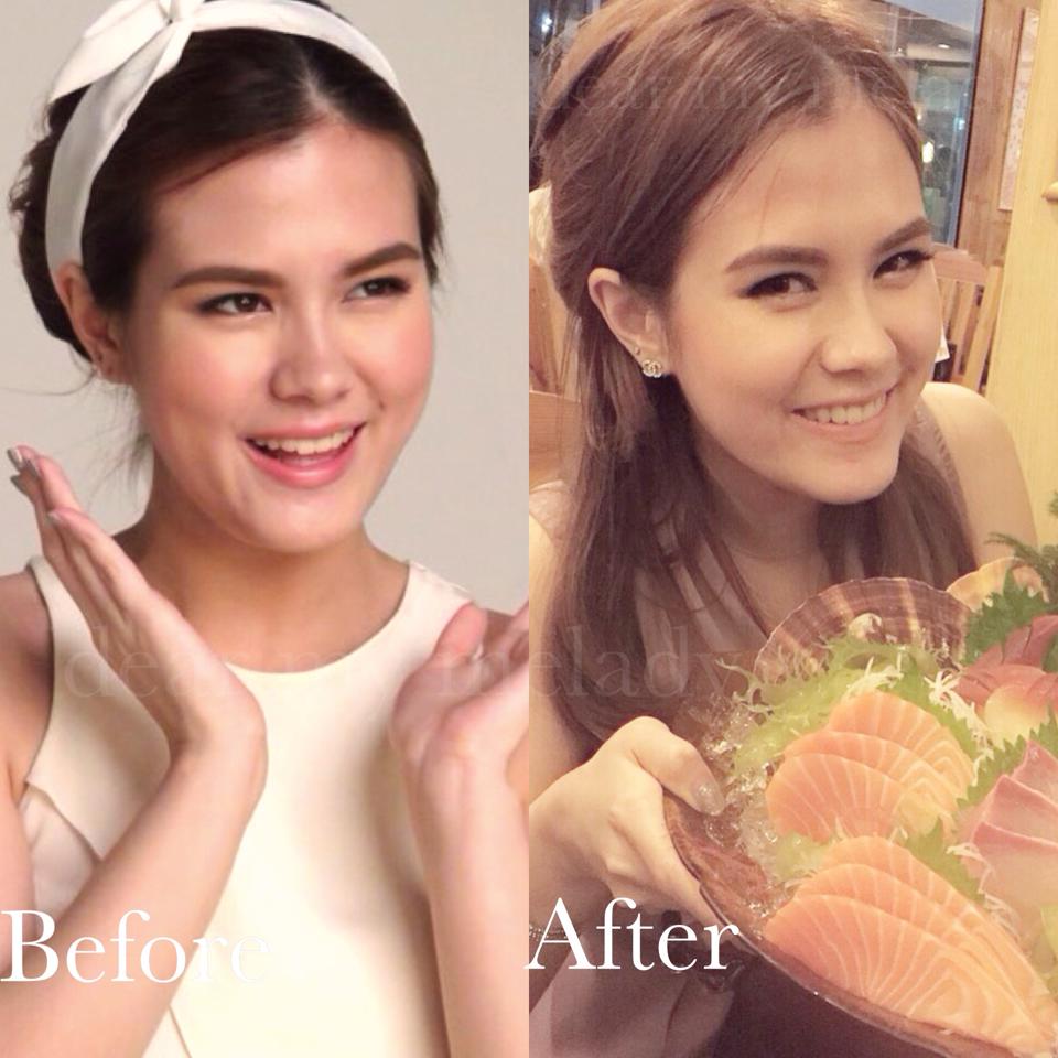 รีวิวฉีด Botox หน้าเรียว + เมโสแฟต ที่Crystal bright clinic