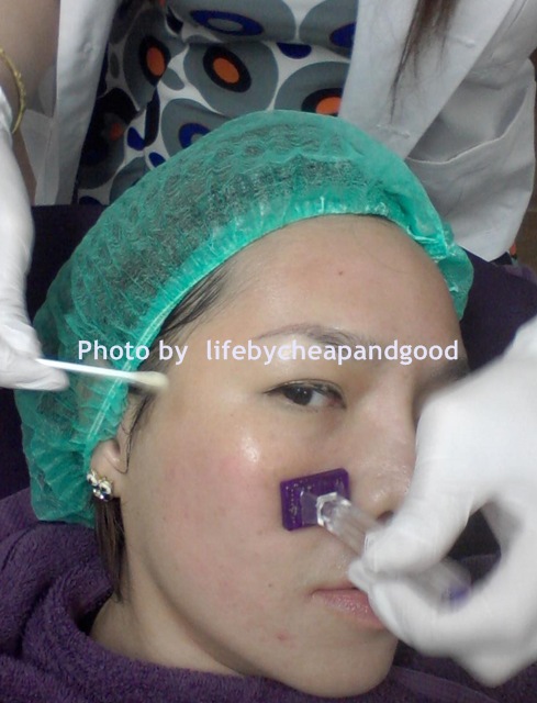 Review Skin Stamping For Acne scar and Rejuvenate