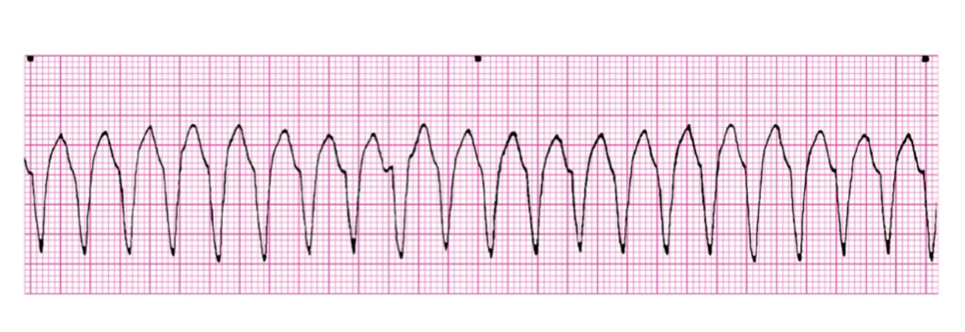 ECG