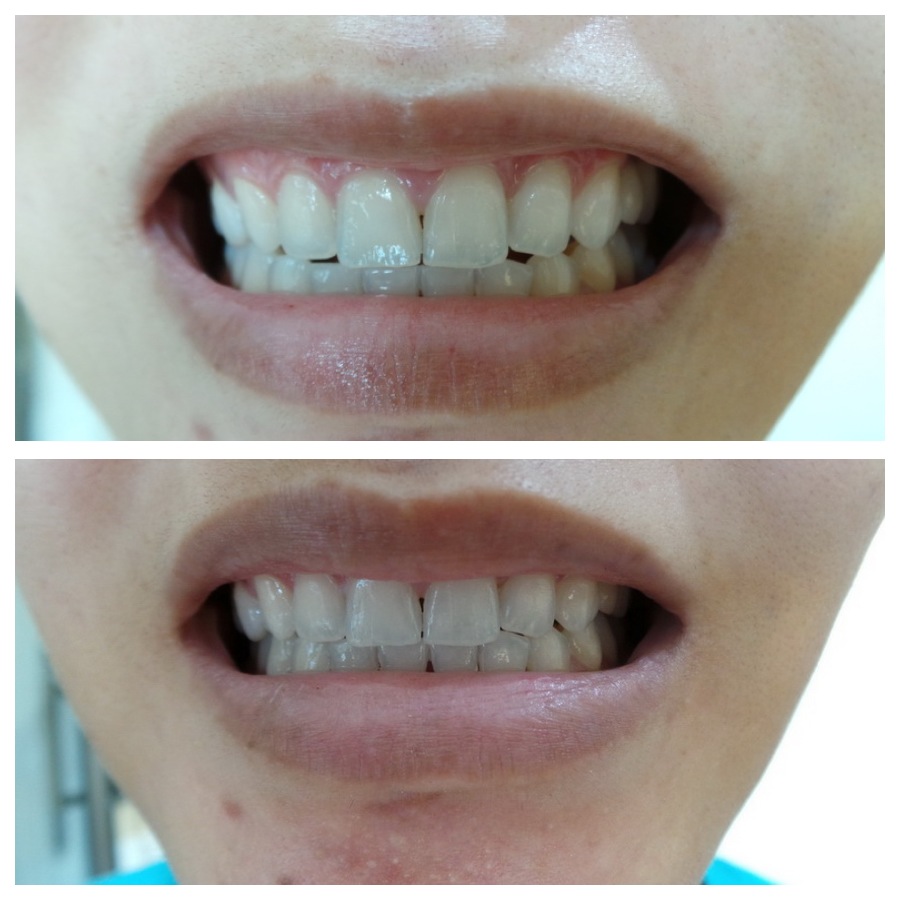 [Review] ฟอกสีฟัน BriteSmile