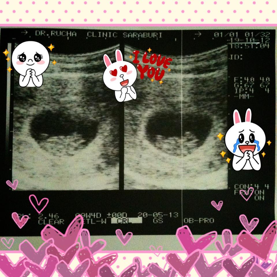9 Weeks 3 Days พบคุณหมอครั้งแรก