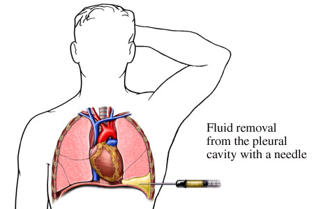การเจาะน้ำในช่องเยื่อหุ้มปอด (Thoracentesis)