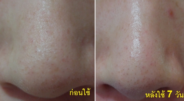 (SR) รีวิวผลิตภัณฑ์รักษาสิว Encapsulated Salicylic Acid (ฺBHA ...