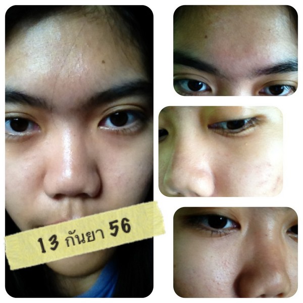 Bloggang.com : waewss16 - [Review] รีวิวพลีชีพ : ผลิตภัณฑ์รักษาสิว
