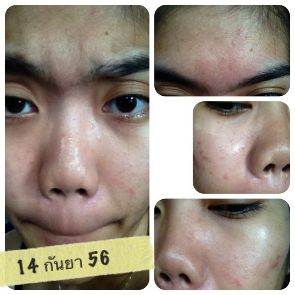 Bloggang.com : waewss16 - [Review] รีวิวพลีชีพ : ผลิตภัณฑ์รักษาสิว