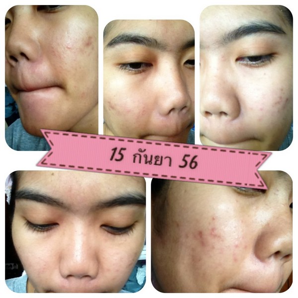 Bloggang.com : waewss16 - [Review] รีวิวพลีชีพ : ผลิตภัณฑ์รักษาสิว