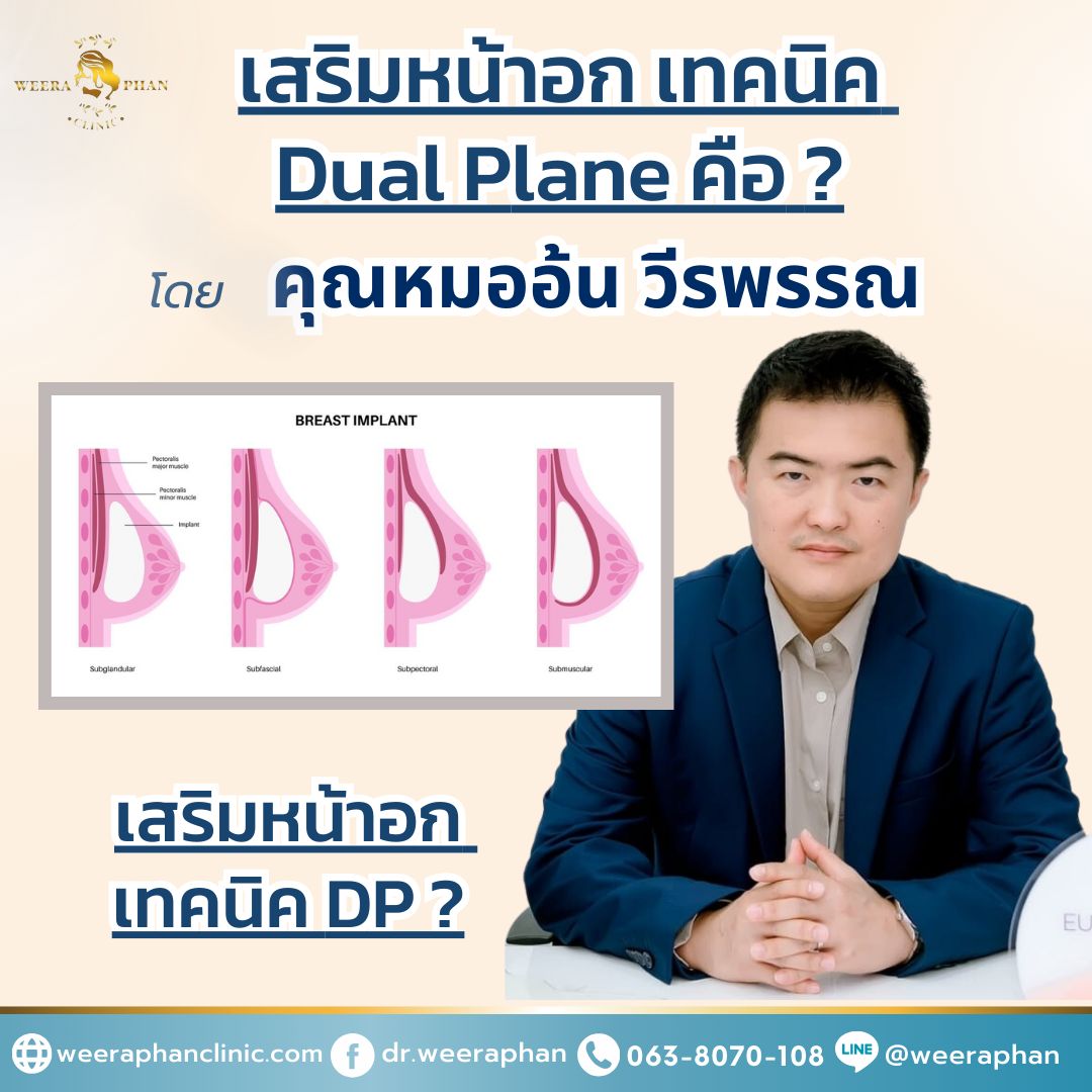 เสริมหน้าอก Dual plane คือ